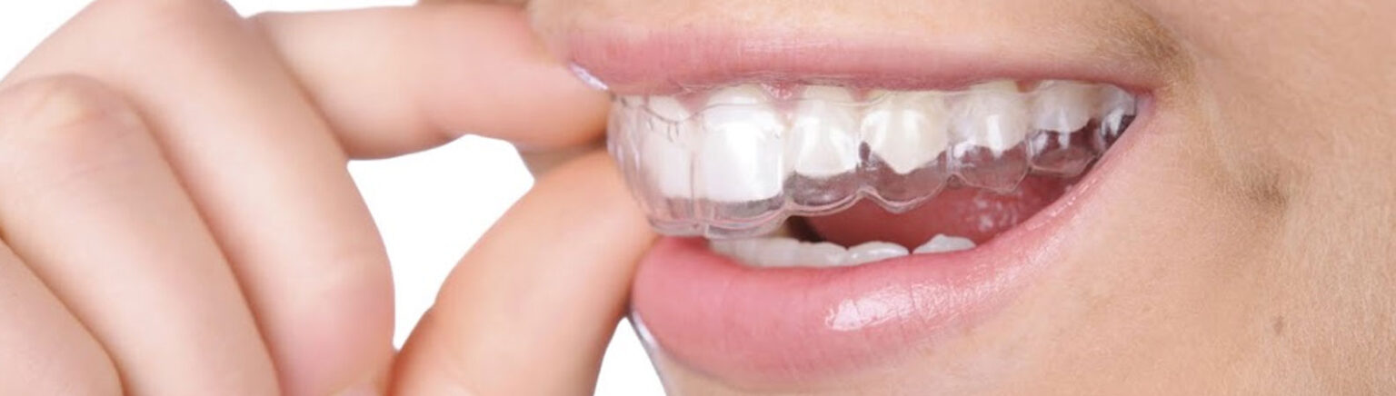 Hear Why Patients Love Invisalign | Parkview Dental